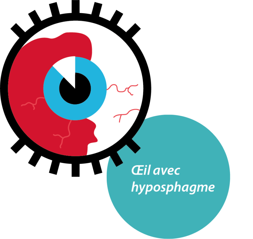 Hyposphagme ou hémorragie sous-conjonctivale